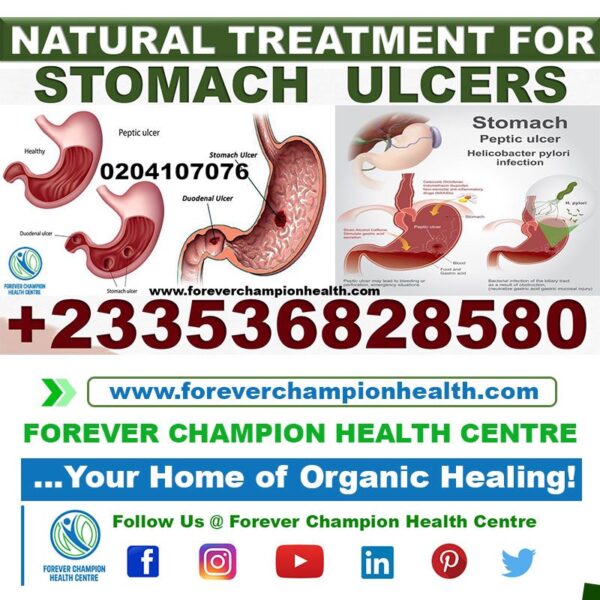 STOMACH ULCER- CAUSES, SYMPTOMS AND TREATMENT - Forever Champion Health ...