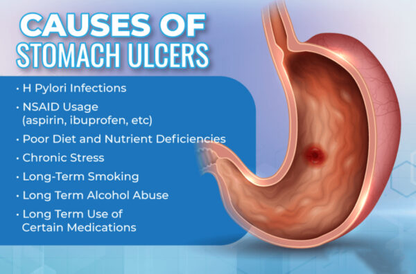 STOMACH ULCER- CAUSES, SYMPTOMS AND TREATMENT - Forever Champion Health ...