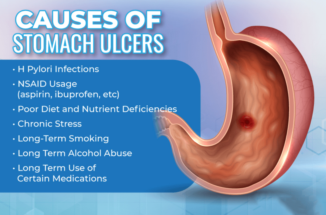 STOMACH ULCER- CAUSES, SYMPTOMS AND TREATMENT - Forever Champion Health ...
