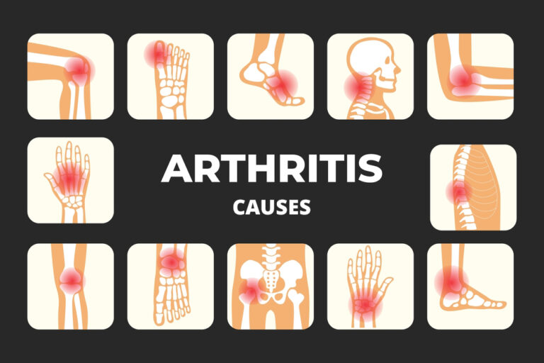 ARTHRITIS (Causes, Symptoms & Treatment) - Forever Champion Health Centre